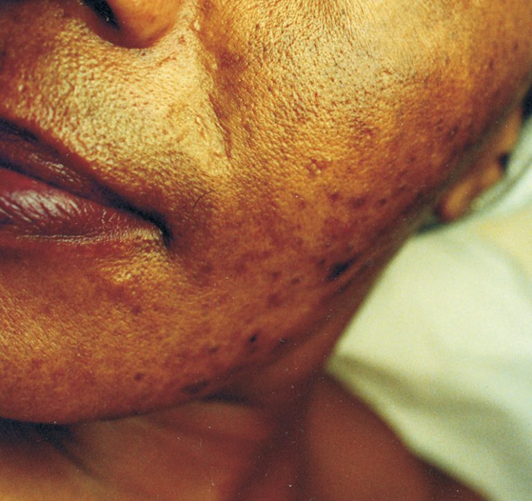 Skin lightening: The facts
